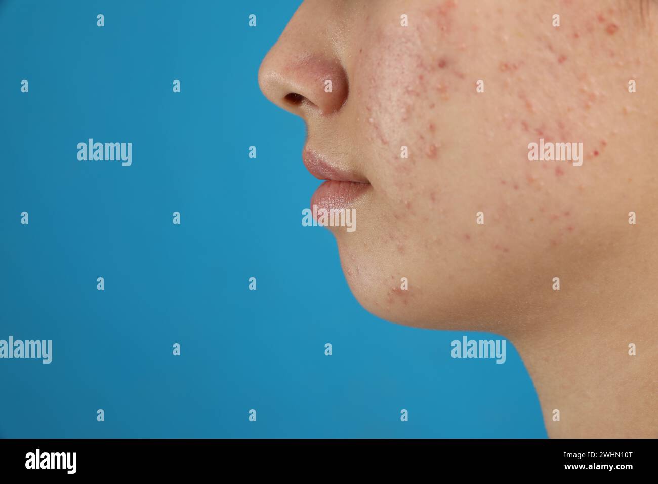 Teenage girl with acne problem on blue background, closeup Stock Photo ...