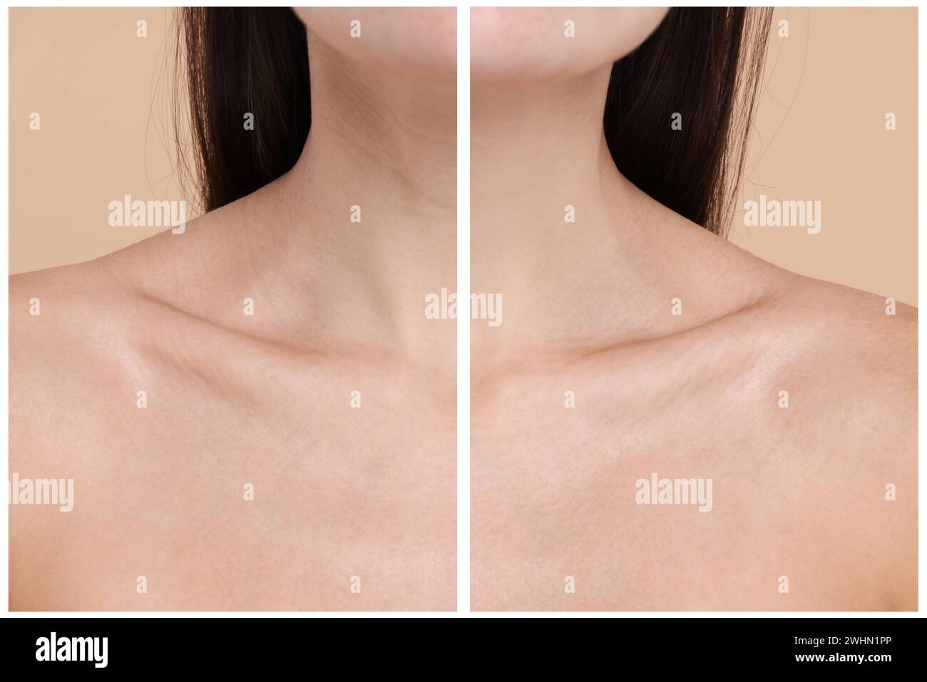Aging skin changes. Woman showing neck before and after rejuvenation ...
