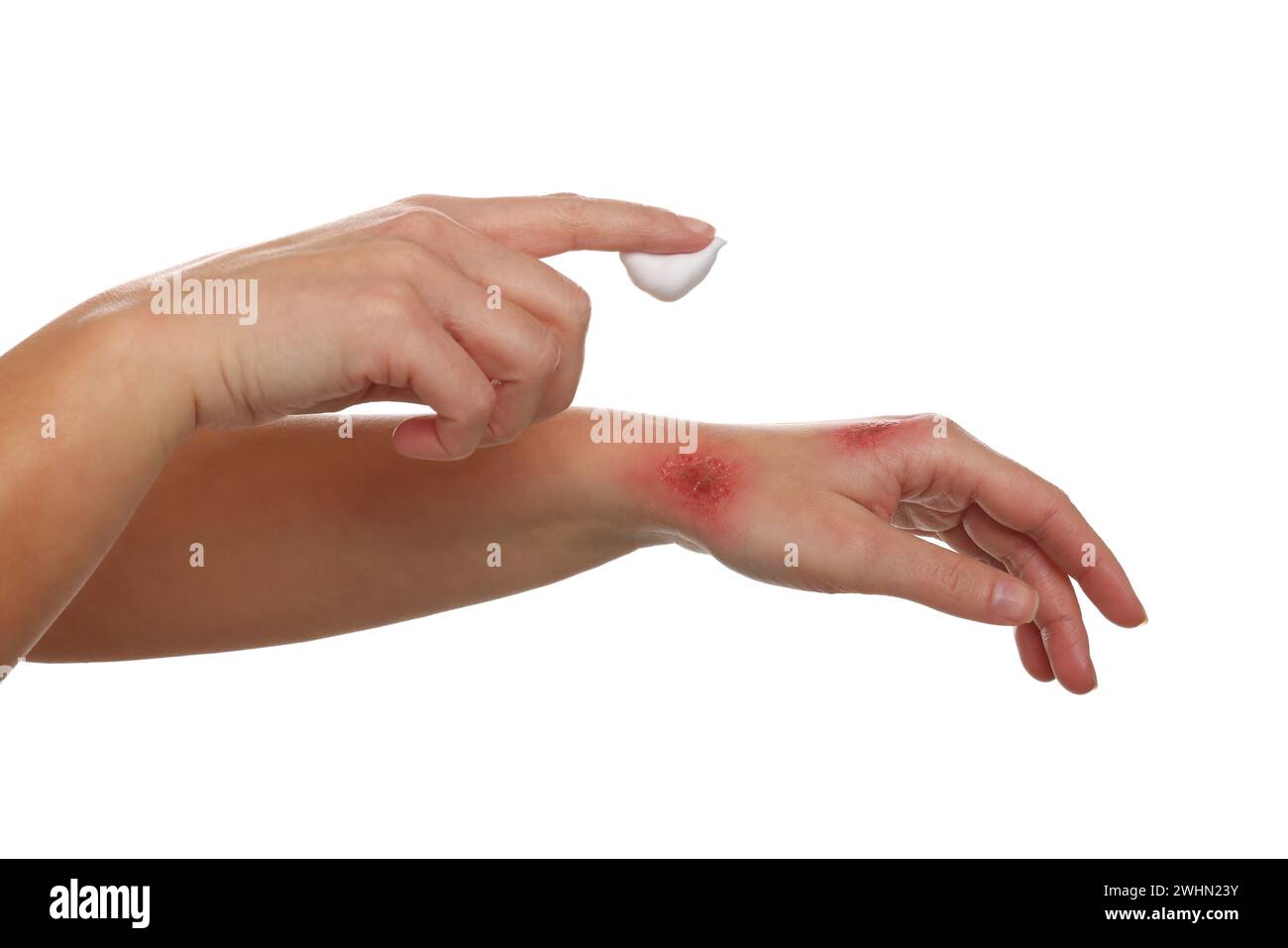 Woman applying panthenol onto burned hand on white background, closeup ...