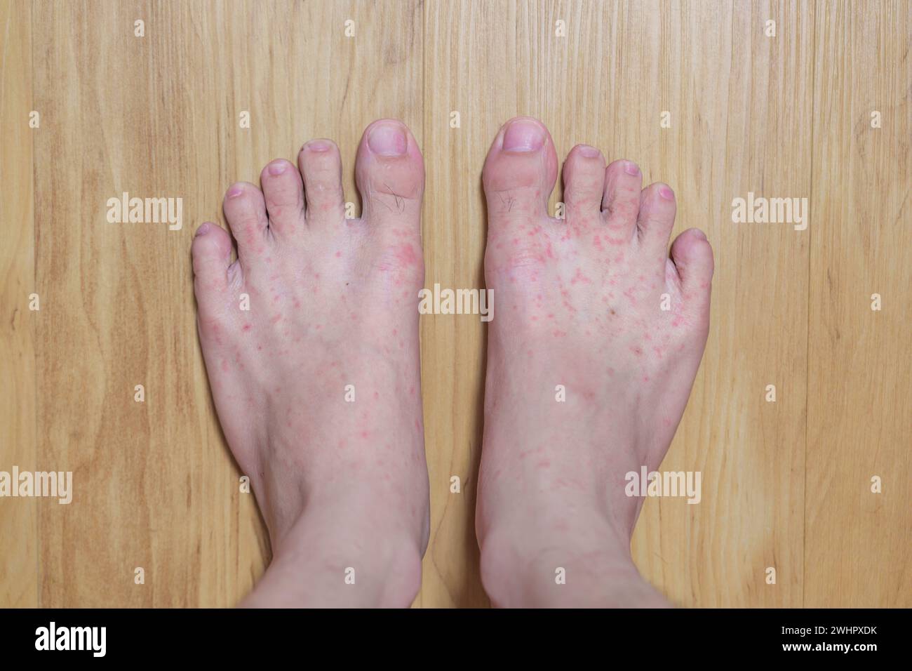 Allergic reaction, Red rash itychy on foot caused by weather or fungi ...