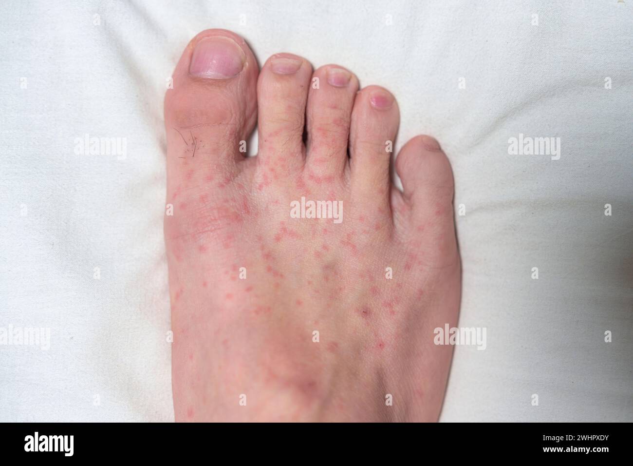 Allergic reaction, Red rash itychy on foot caused by weather or fungi ...