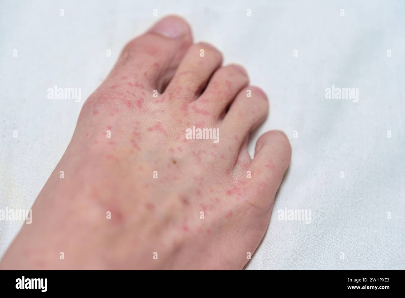 Allergic reaction, Red rash itychy on foot caused by weather or fungi ...