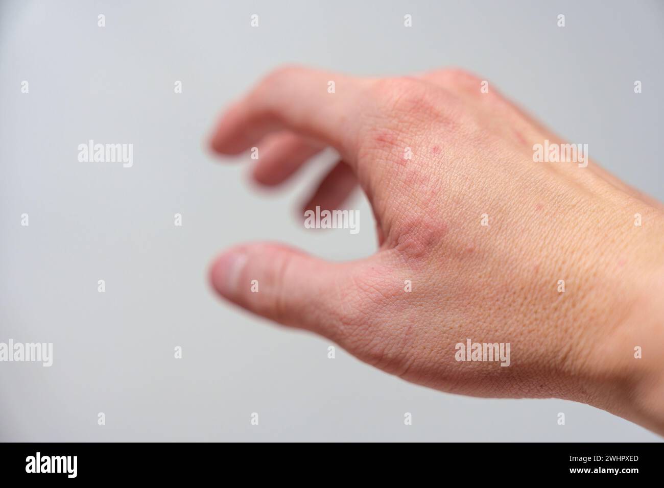 Allergic reaction, Red rash itychy on hand caused by weather or fungi ...