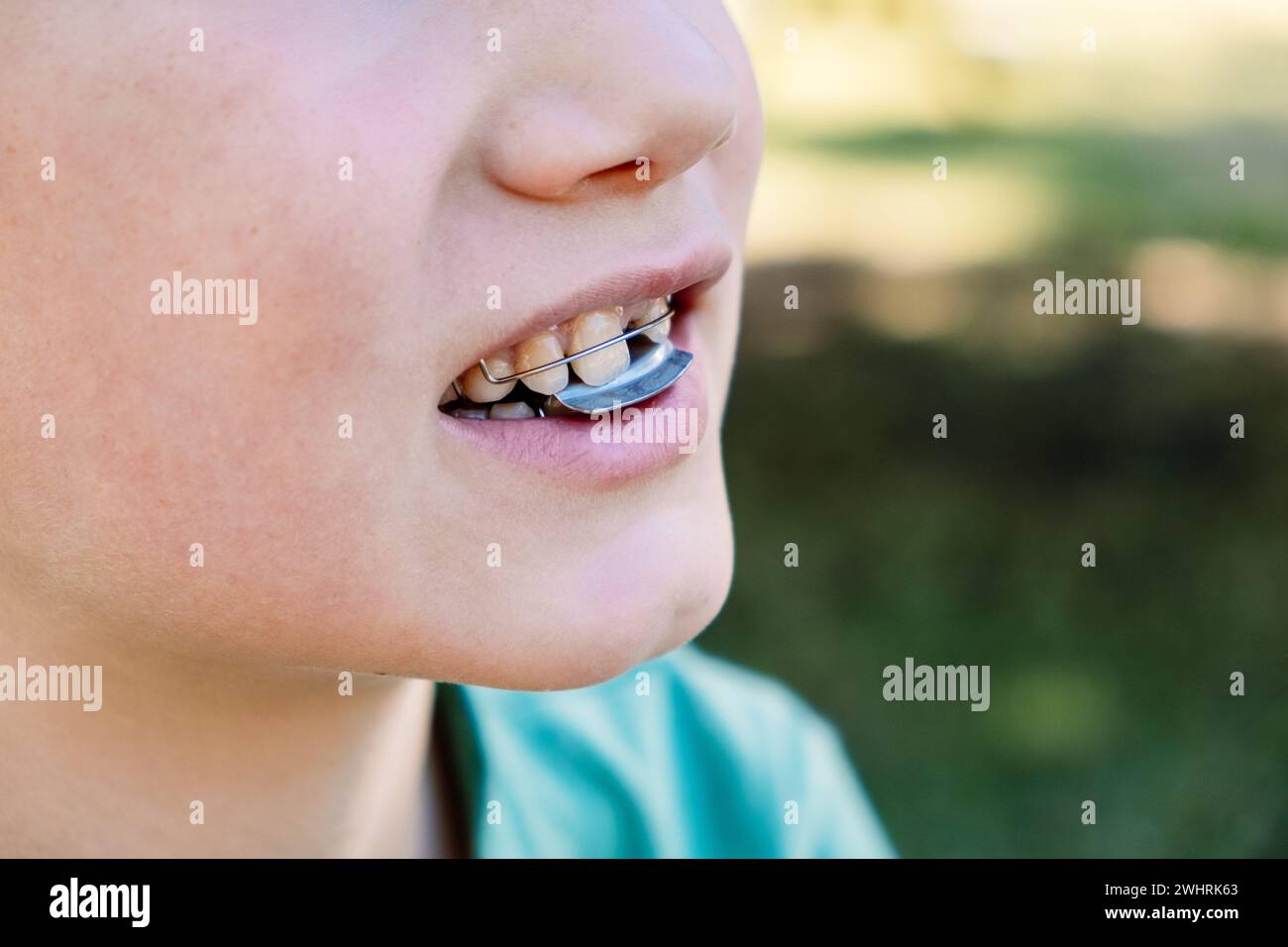 Child with orthodontic appliance to correct malocclusion, forward bite ...