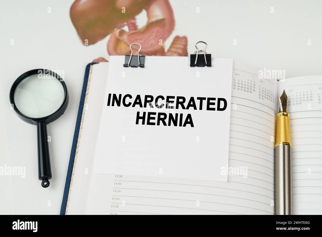 Inguinal hernia hi-res stock photography and images - Alamy