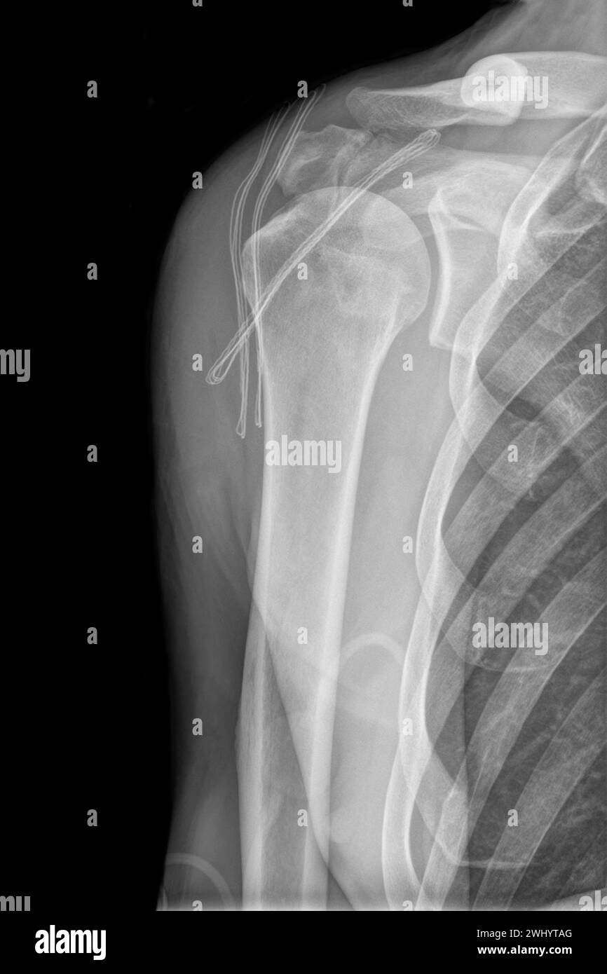 Xray image of shoulder isolated on black background. Chronic ...