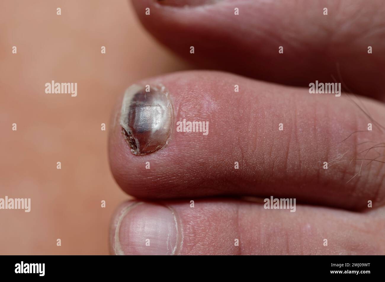 The long toe, the one next to the big toe's, toenail is black due to ...