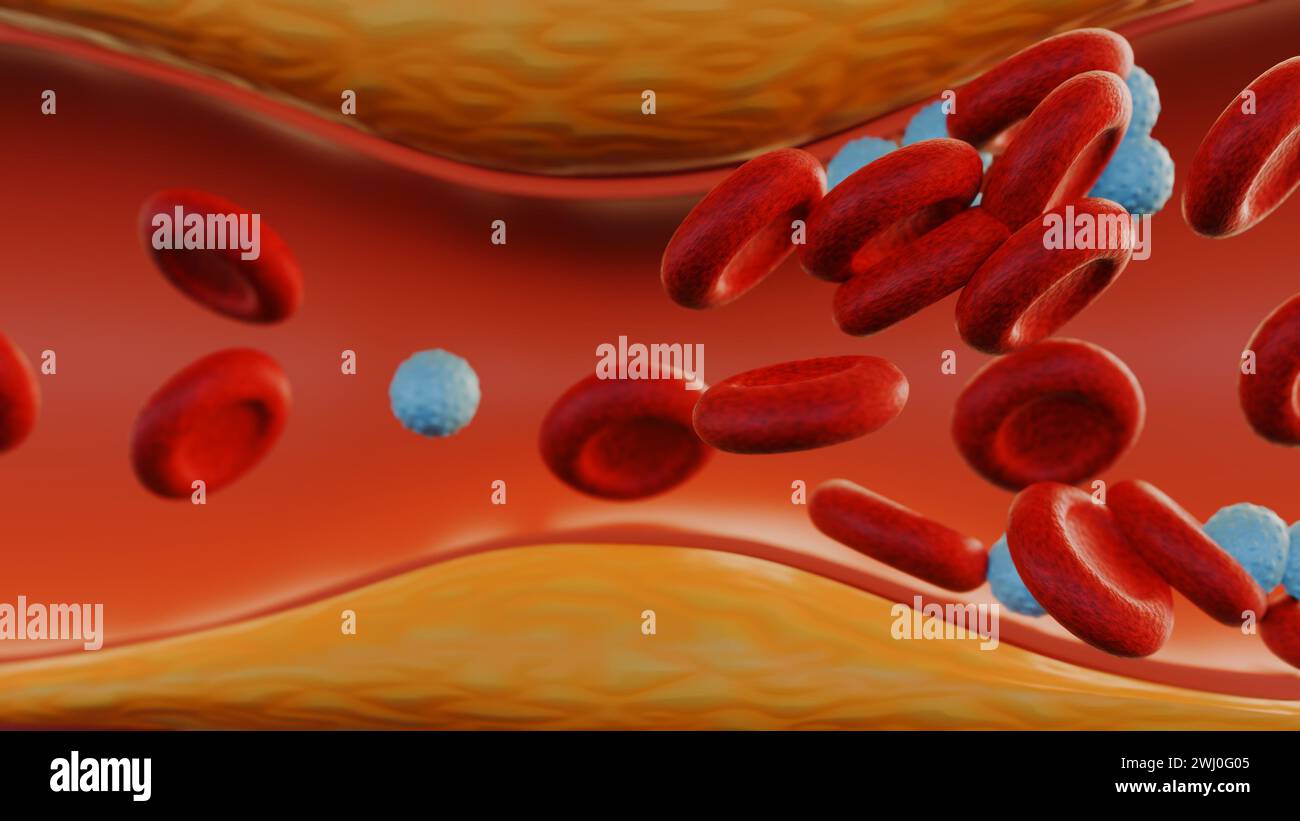 3d rendering of plaque formation of Cholesterol in artery ...