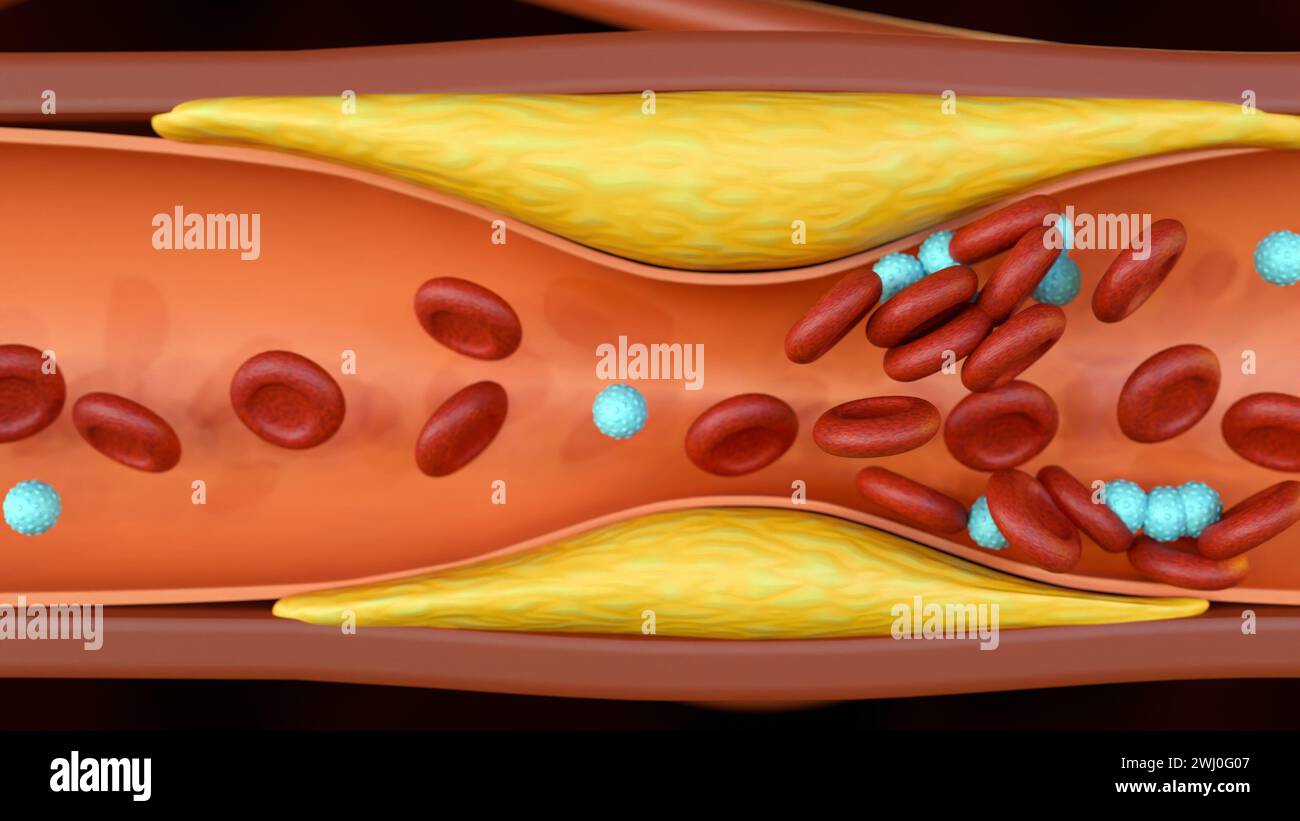 3d rendering of plaque formation of Cholesterol in artery ...