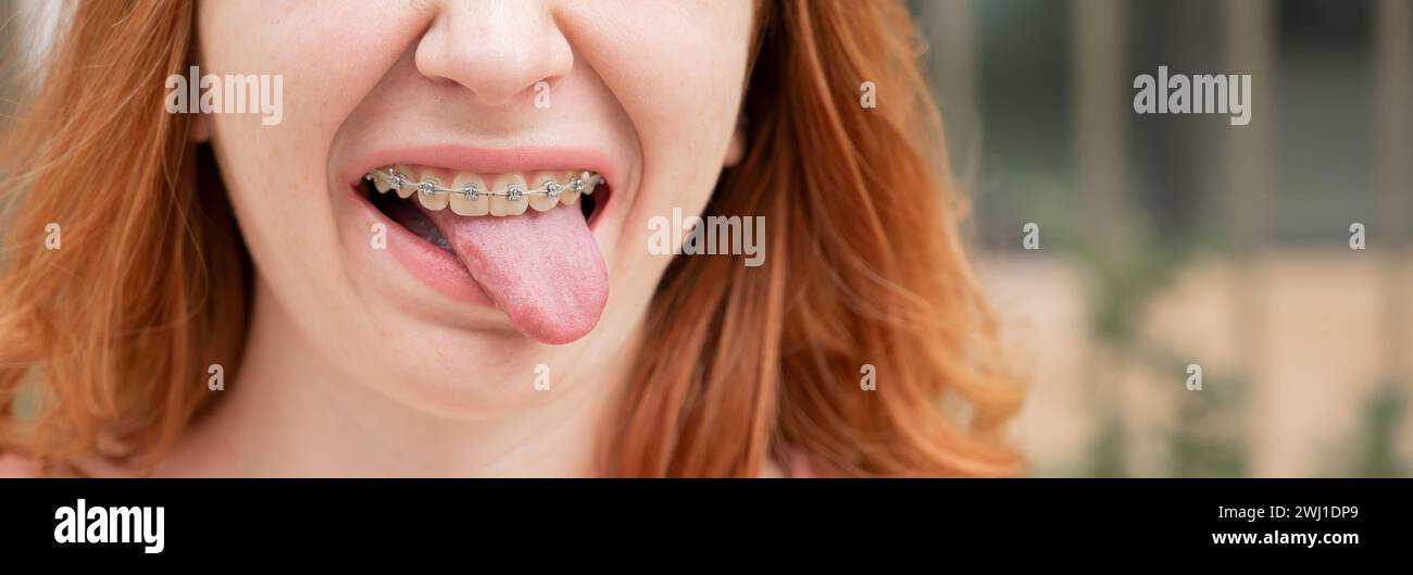 Young woman with braces on her teeth smiles and shows her tongue ...