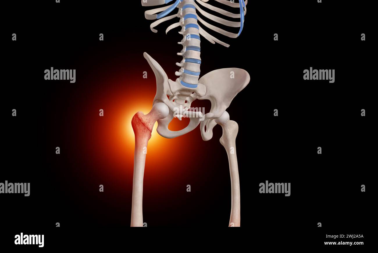 Intertrochanteric fracture on the femur head skeleton 3D medical ...