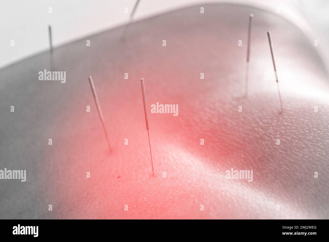 Close-up of female body with steel needles inserted during procedure of ...