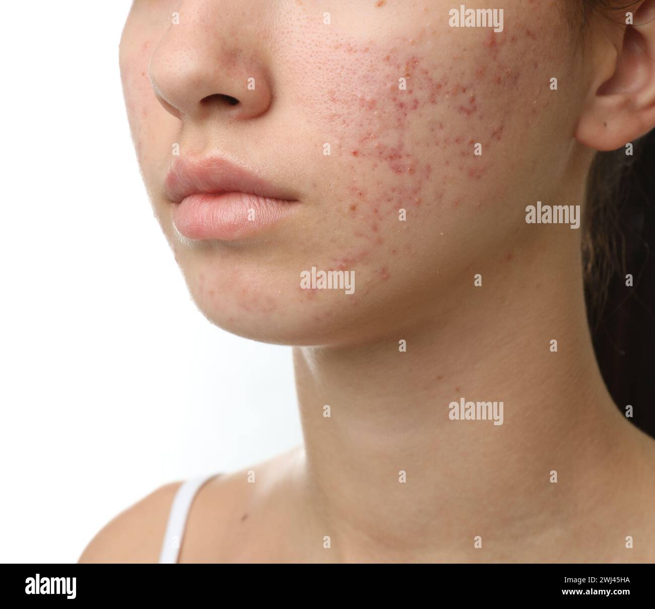 Teenage girl with acne problem on white background, closeup Stock Photo ...