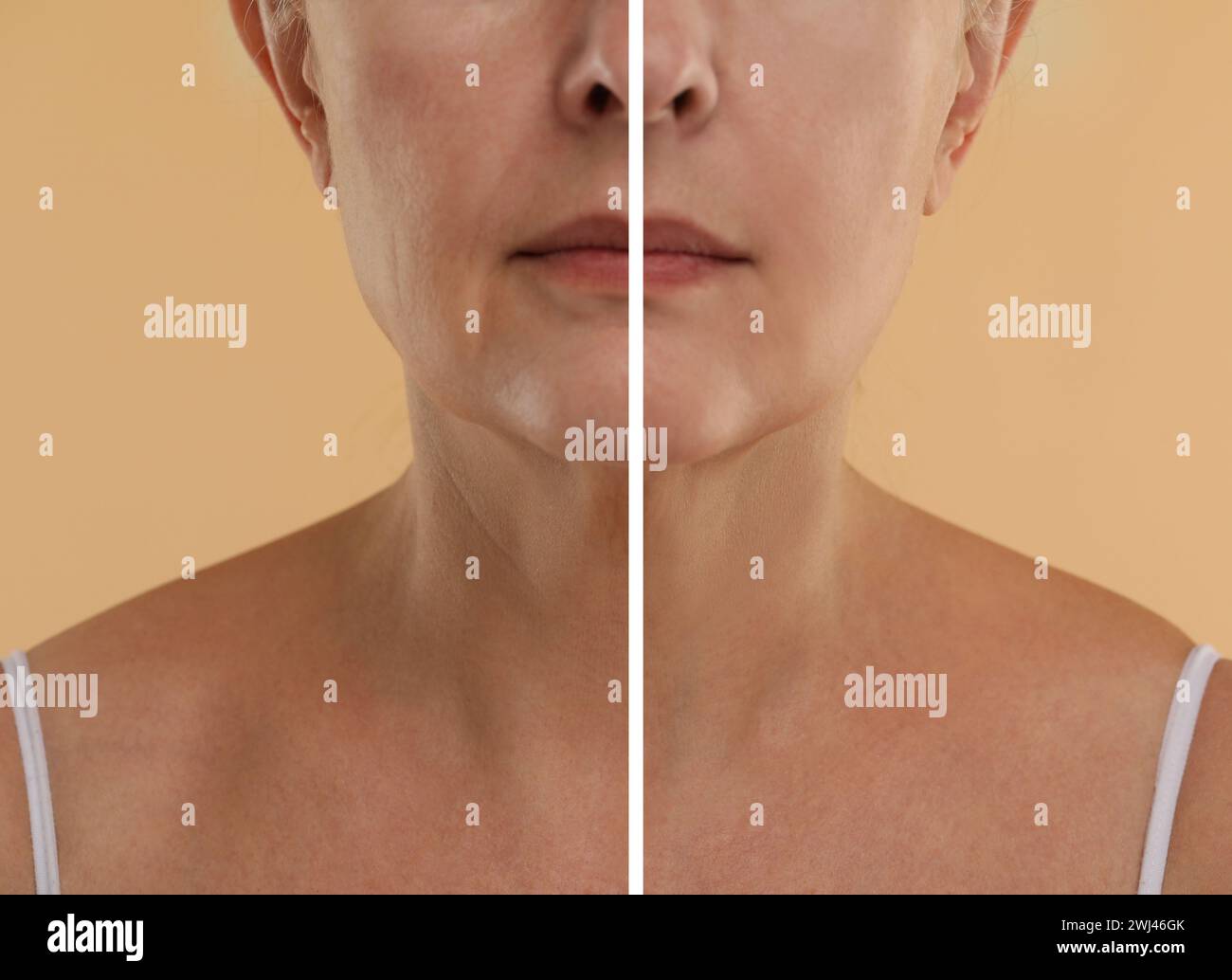 Aging skin changes. Woman showing neck before and after rejuvenation ...