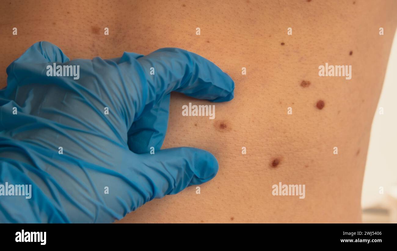 Doctor in medical gloves examining man skin mole. Dermatologist ...