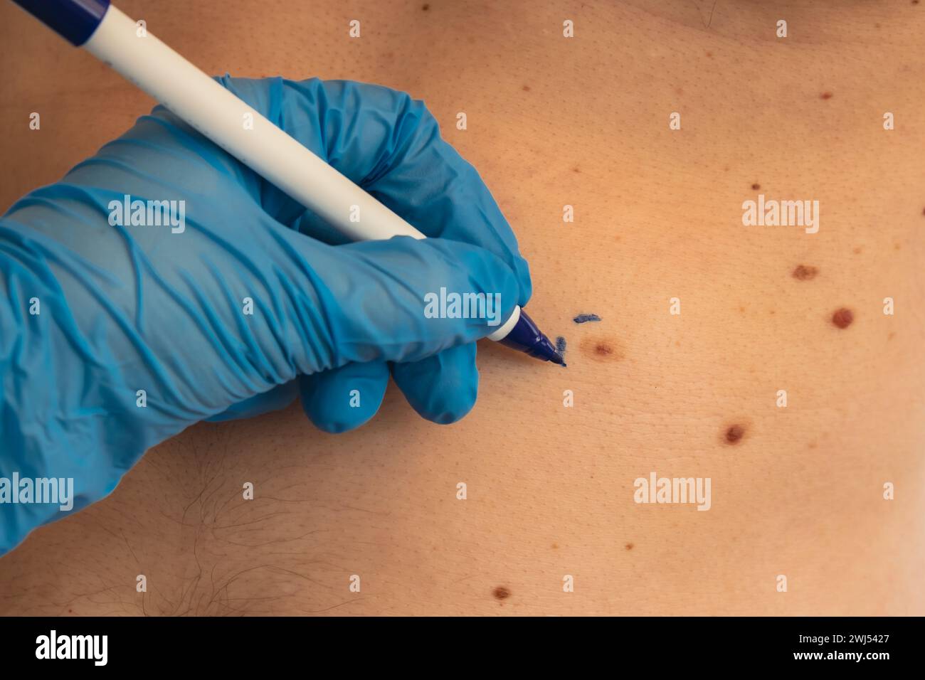 Preparing procedure for medical skin surgery. Unrecognizable Doctor in ...