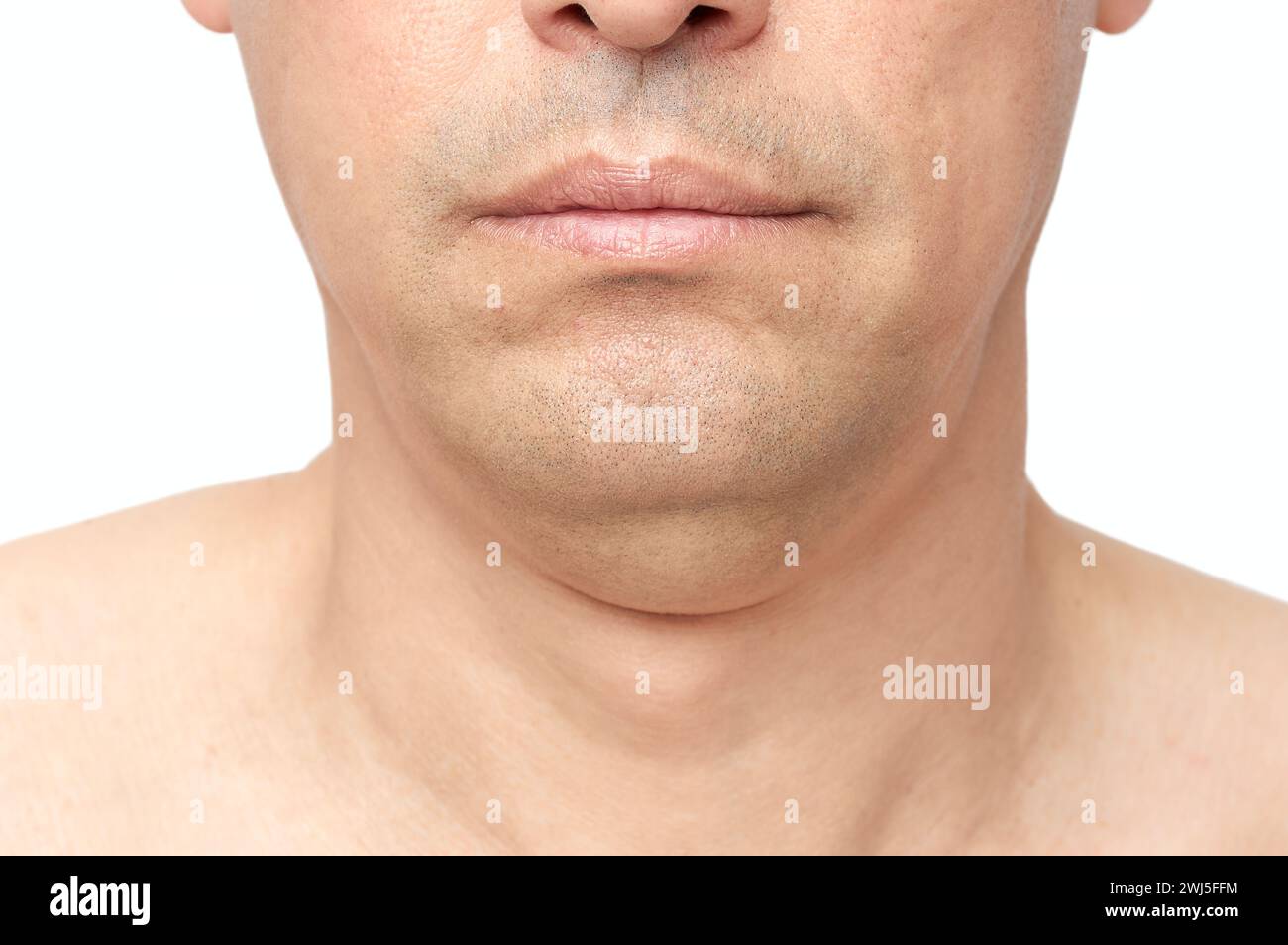 Man a double fat chin, a problem with a hanging chin with white ...