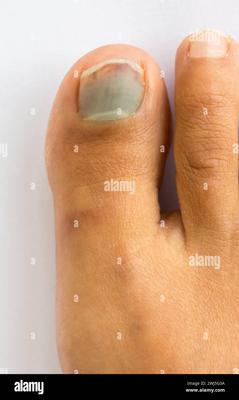 close up of subungual hematoma blue and black toe nail Stock Photo - Alamy