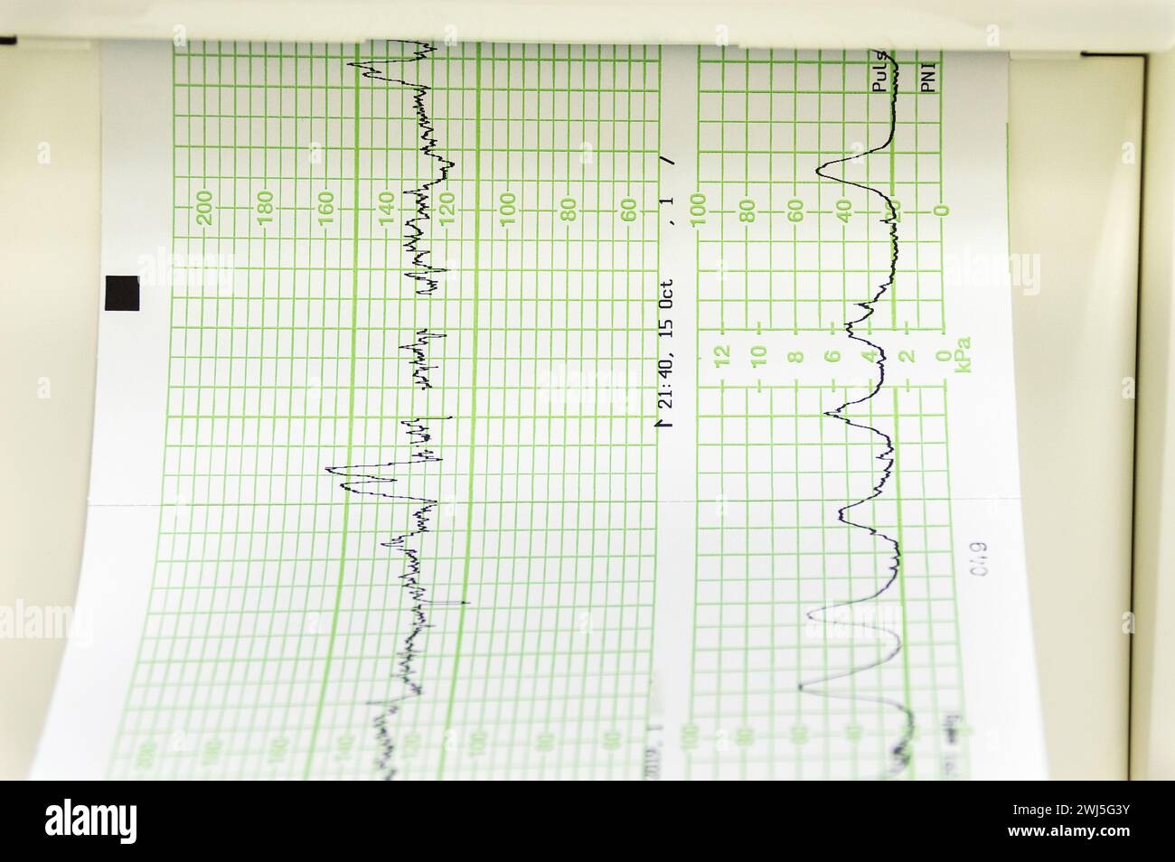 Electrocardiogram in paper form, closeup Stock Photo - Alamy