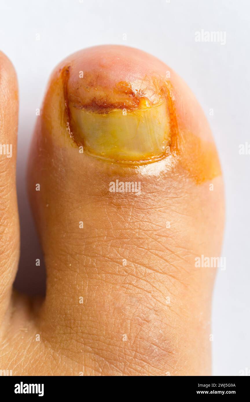 The left toe has been injured in an accident Is a swelling redness ...
