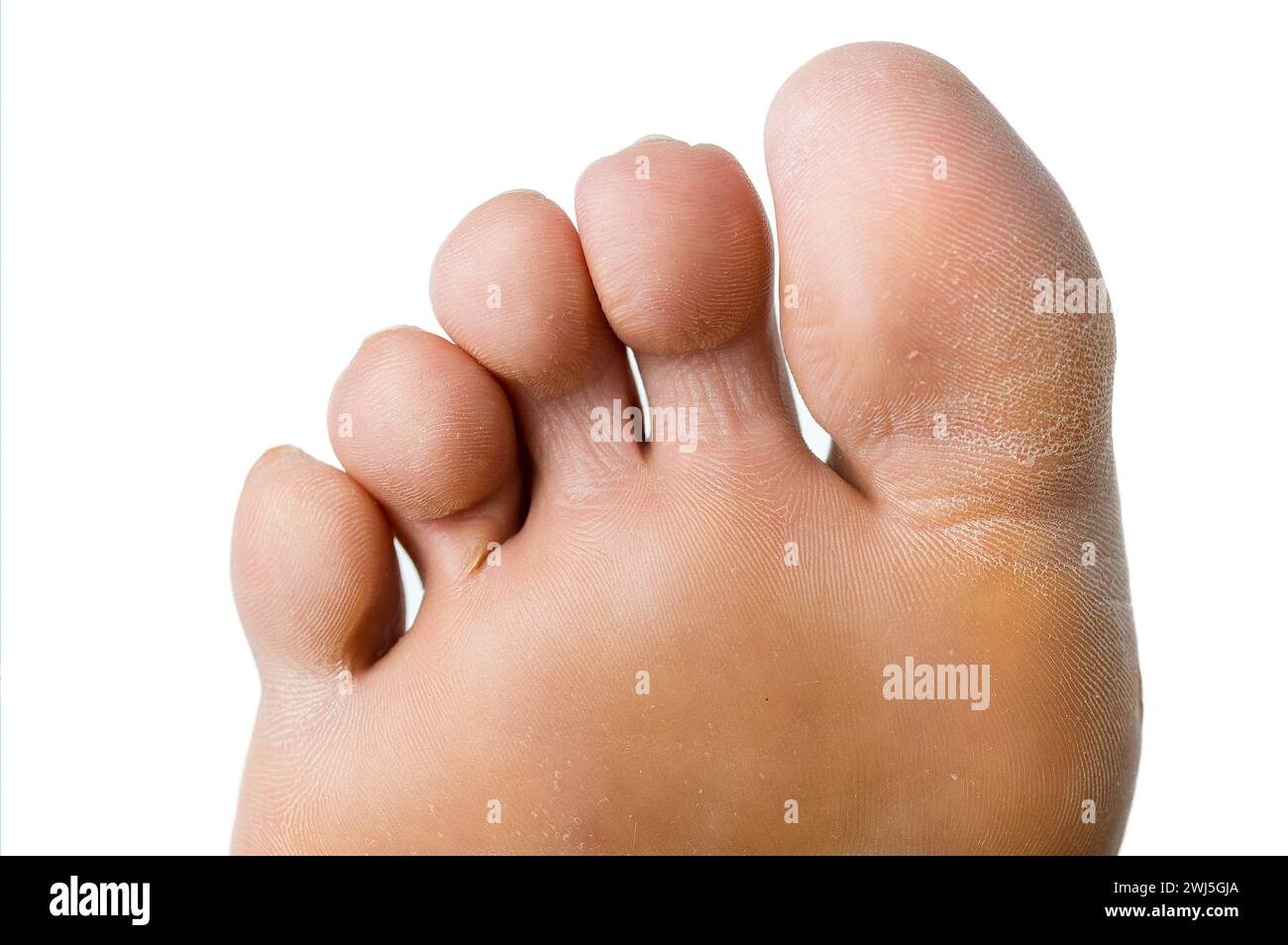 Close up foot of a woman with dry and hardened skin Stock Photo - Alamy
