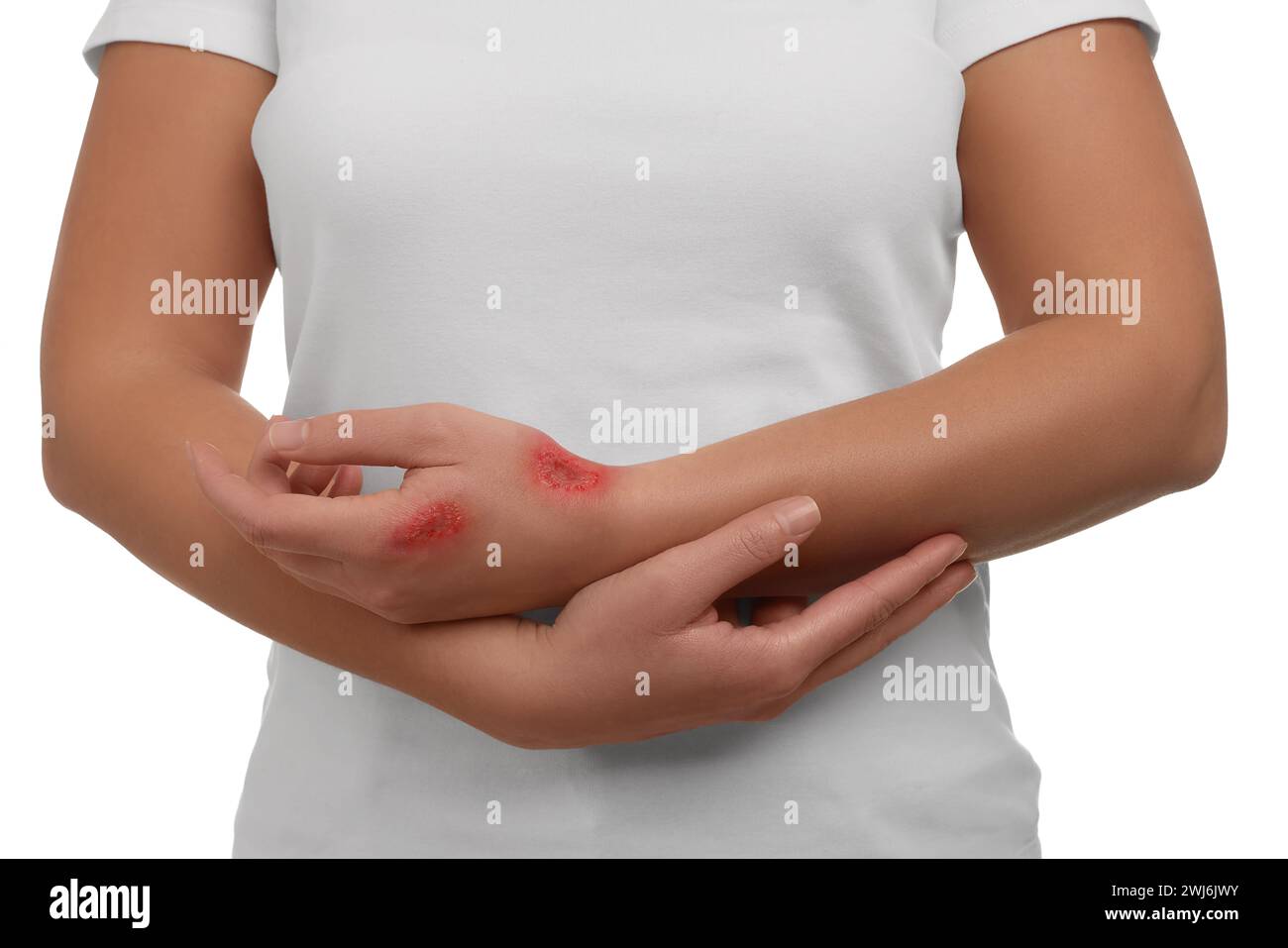 Burn mark on hand hi-res stock photography and images - Alamy