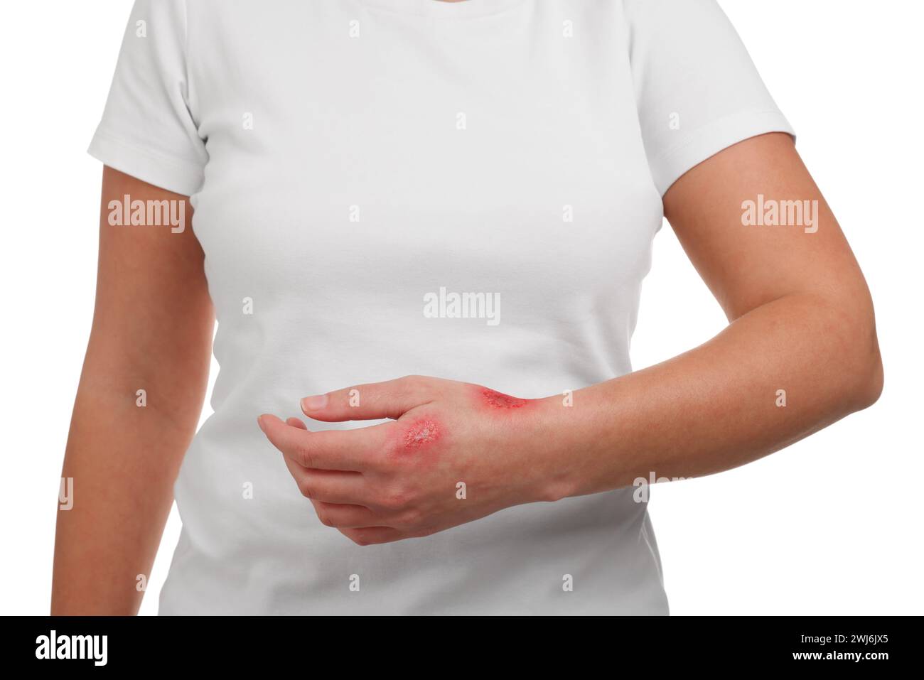 Burn mark on hand hi-res stock photography and images - Alamy