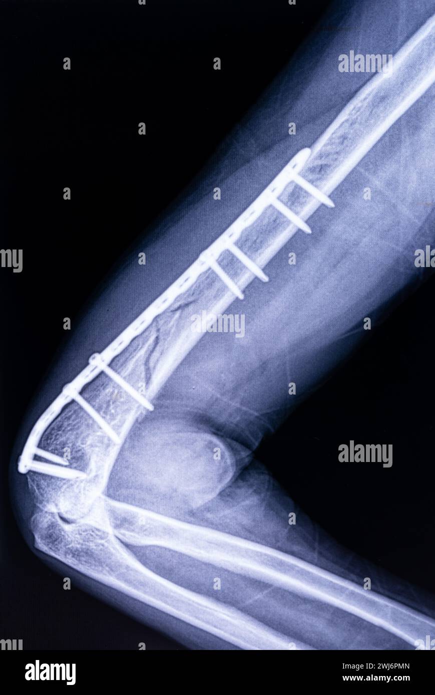 X-ray image of osteosynthesis of the humerus of the left arm of a man ...