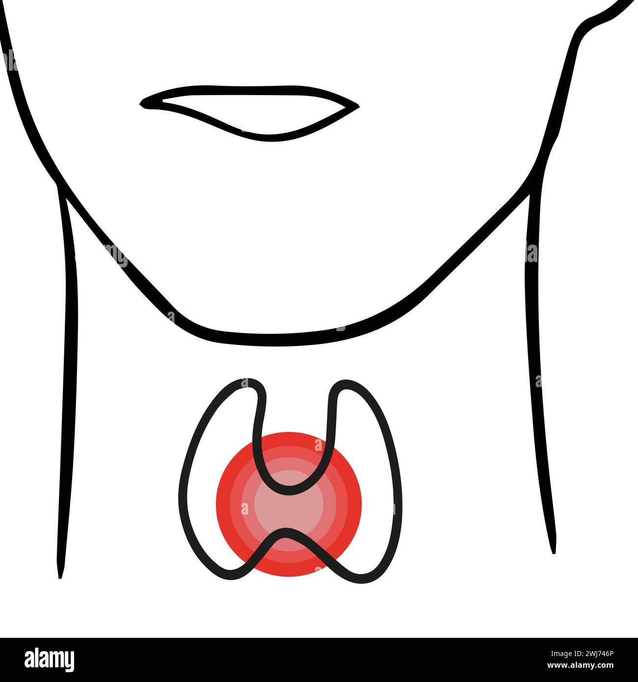 Vector Isolated Illustration Of Thyroid Gland Enlarged Thyroid Gland Stock Vector Image And Art