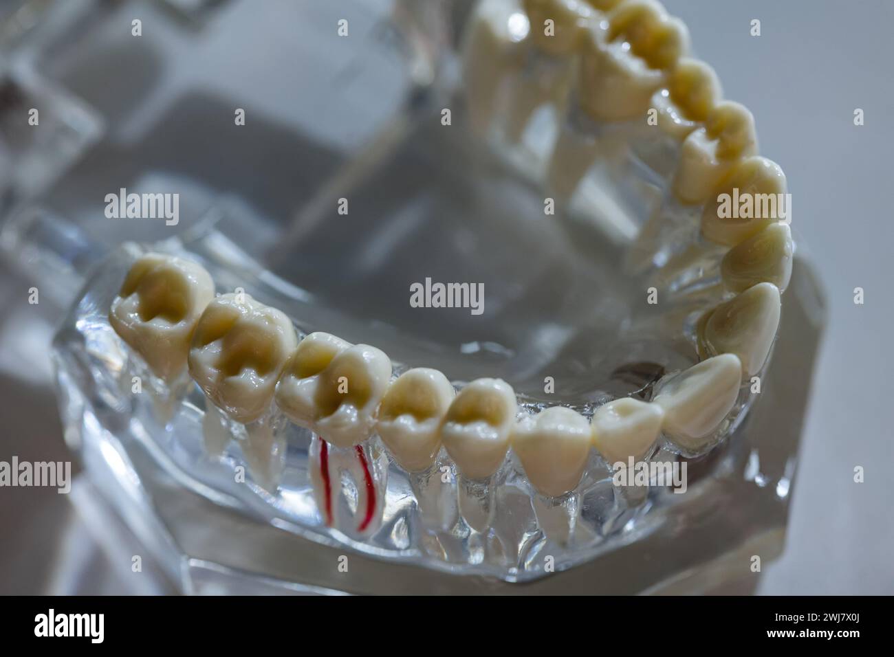 Caries tooth model, oral care concept. Dental model present common ...