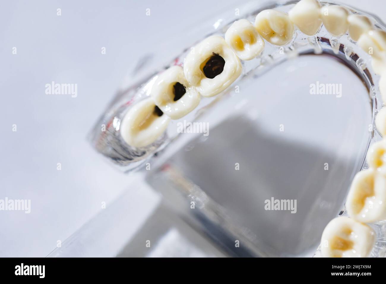 Caries tooth model, oral care concept. Dental model present common ...
