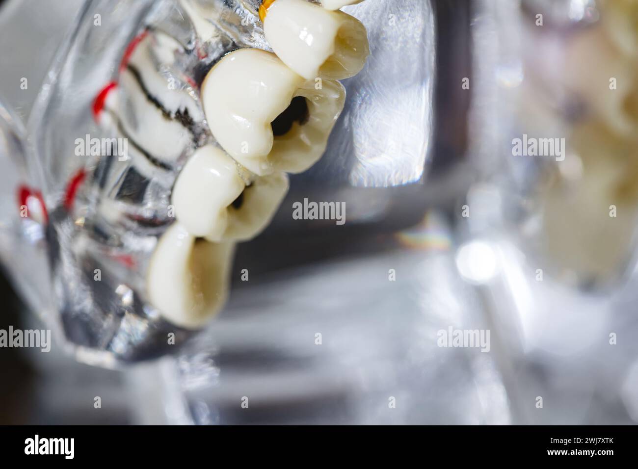 Caries tooth model, oral care concept. Dental model present common ...