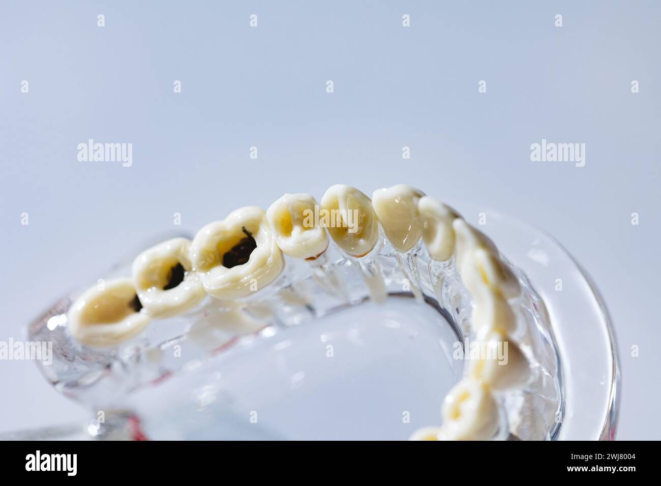Caries tooth model, oral care concept. Dental model present common ...