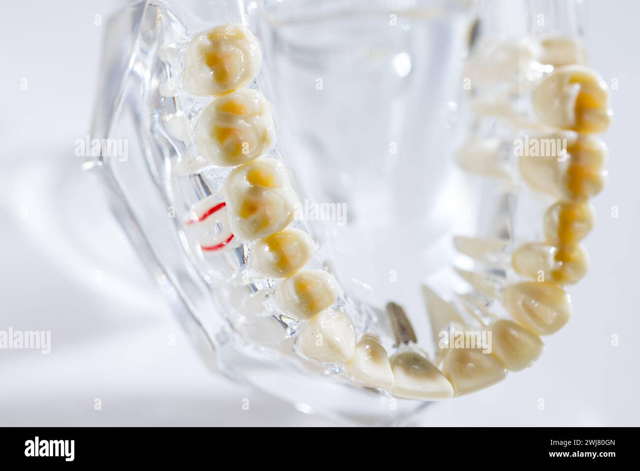 Dental implant, artificial tooth roots into jaw, root canal of dental ...