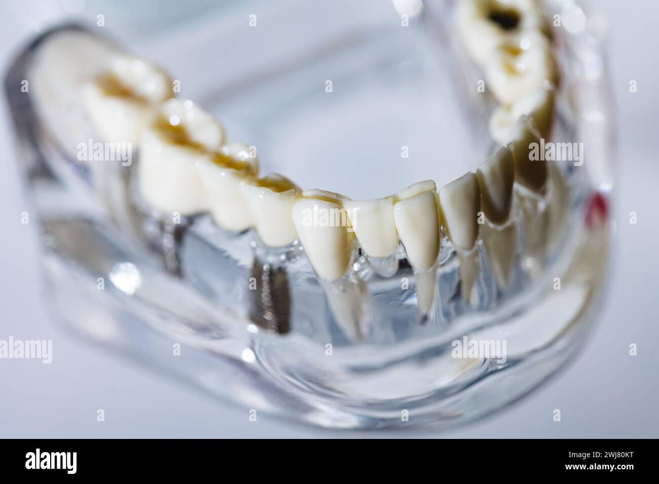 Dental implant, artificial tooth roots into jaw, root canal of dental ...
