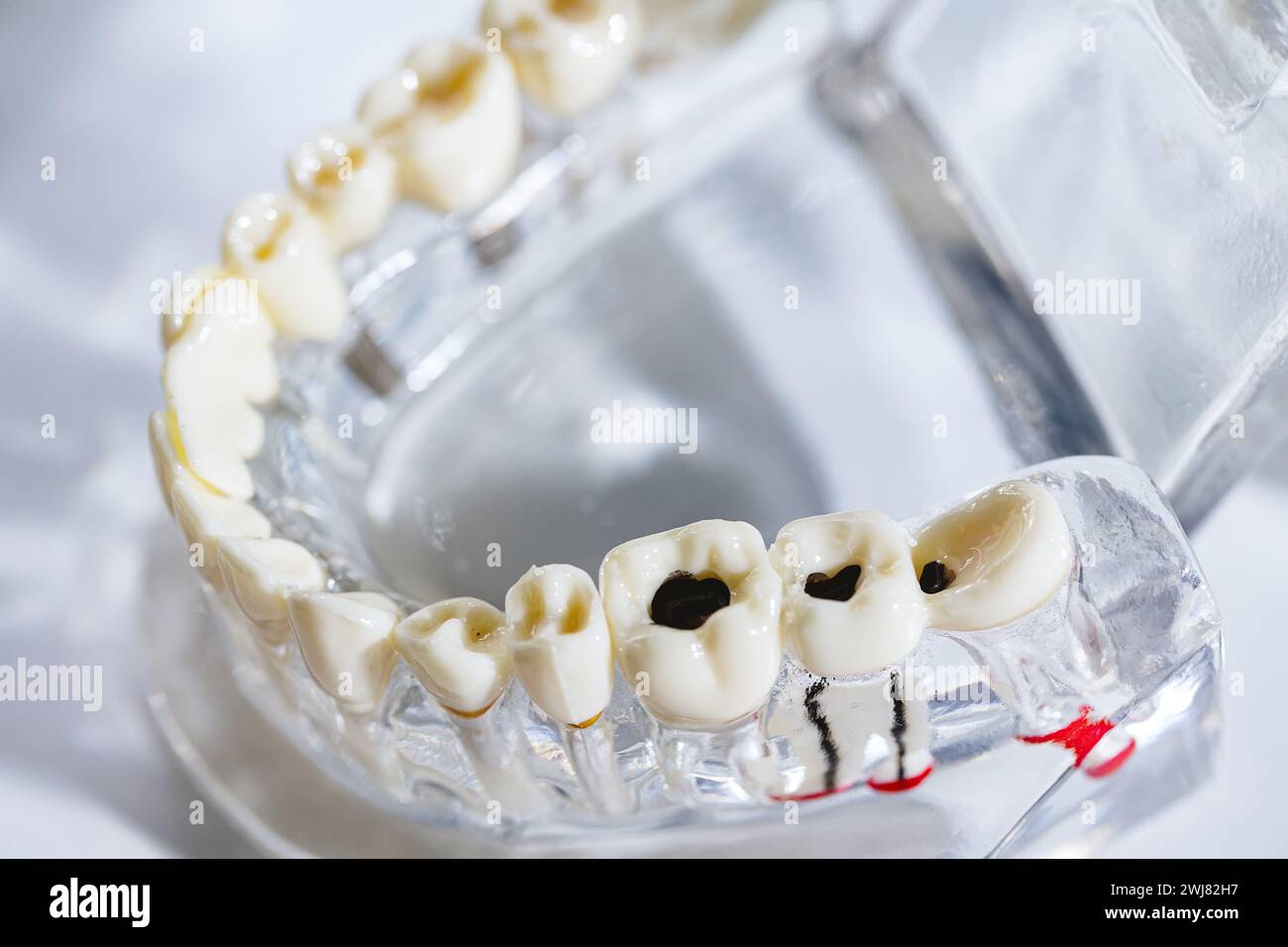 Caries tooth model, oral care concept. Dental model present common ...