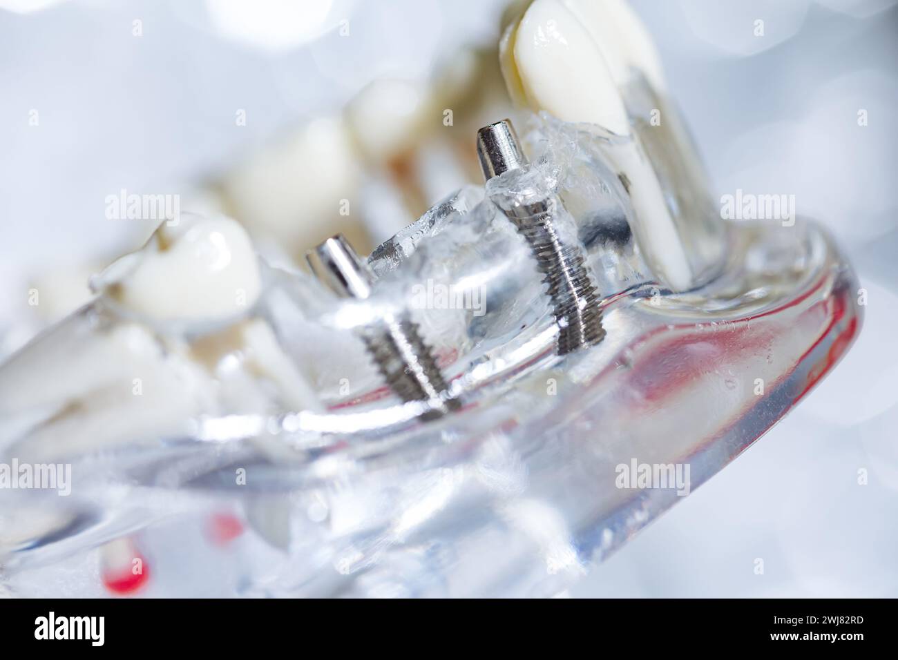 Dental tooth implant titanium prosthetic dentists model. Shallow dof ...