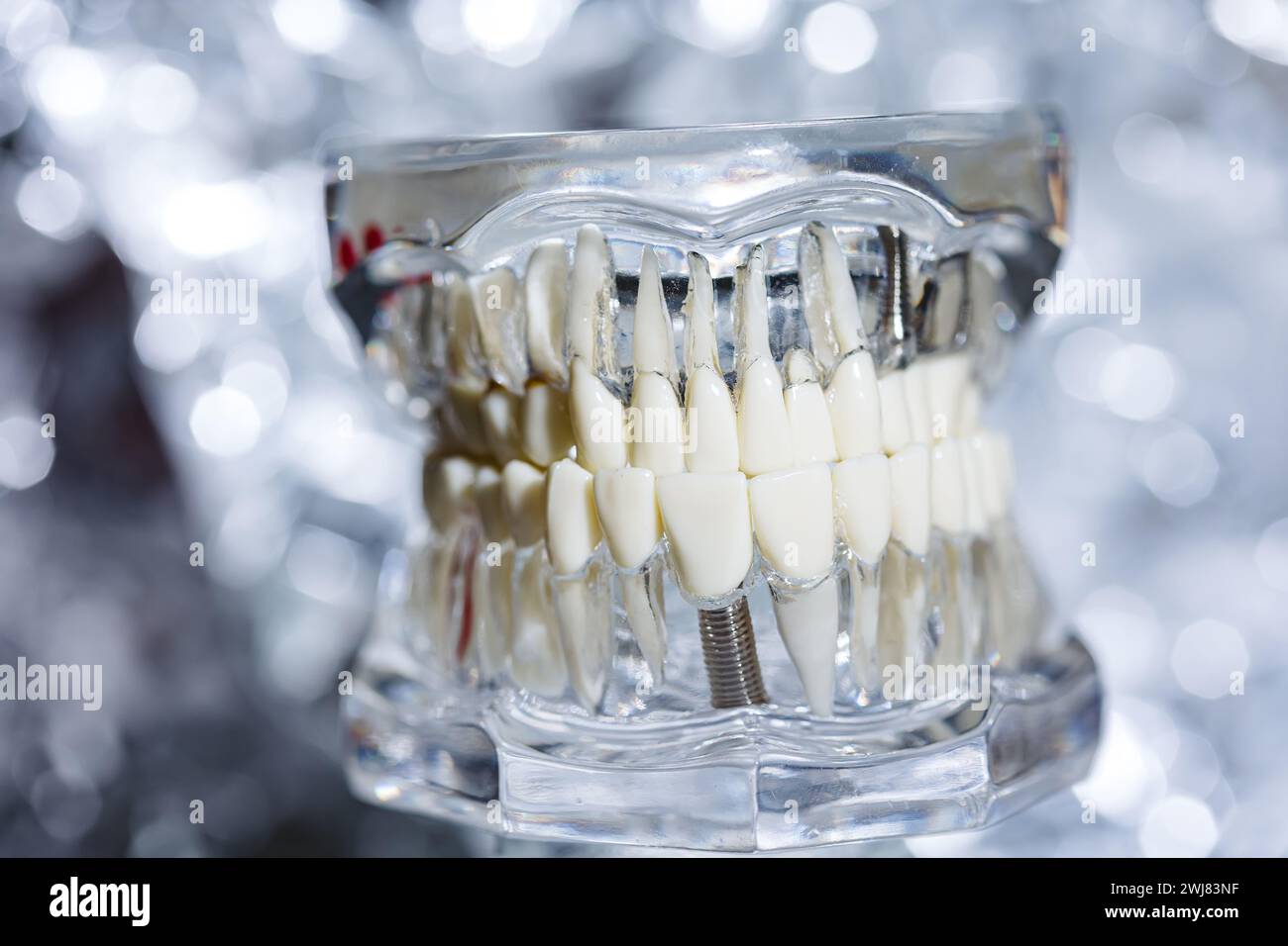 Dental tooth implant titanium prosthetic dentists model. Shallow dof ...