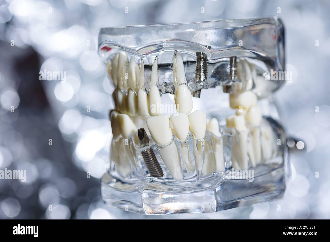 Dental tooth implant titanium prosthetic dentists model. Shallow dof ...