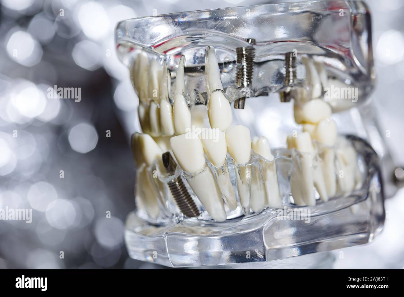 Dental tooth implant titanium prosthetic dentists model. Shallow dof ...