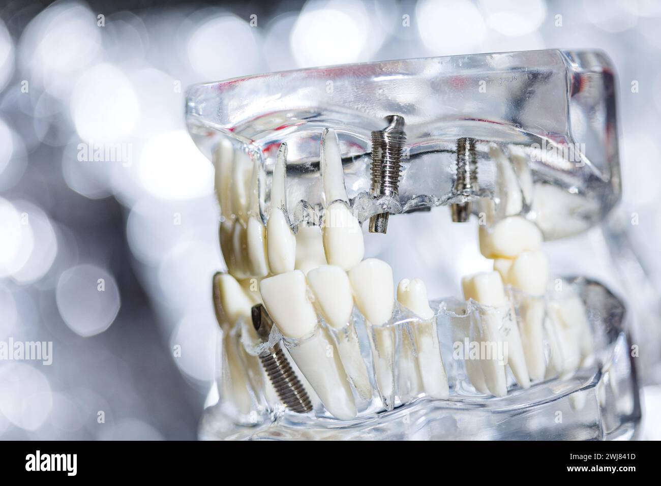 Dental tooth implant titanium prosthetic dentists model. Shallow dof ...