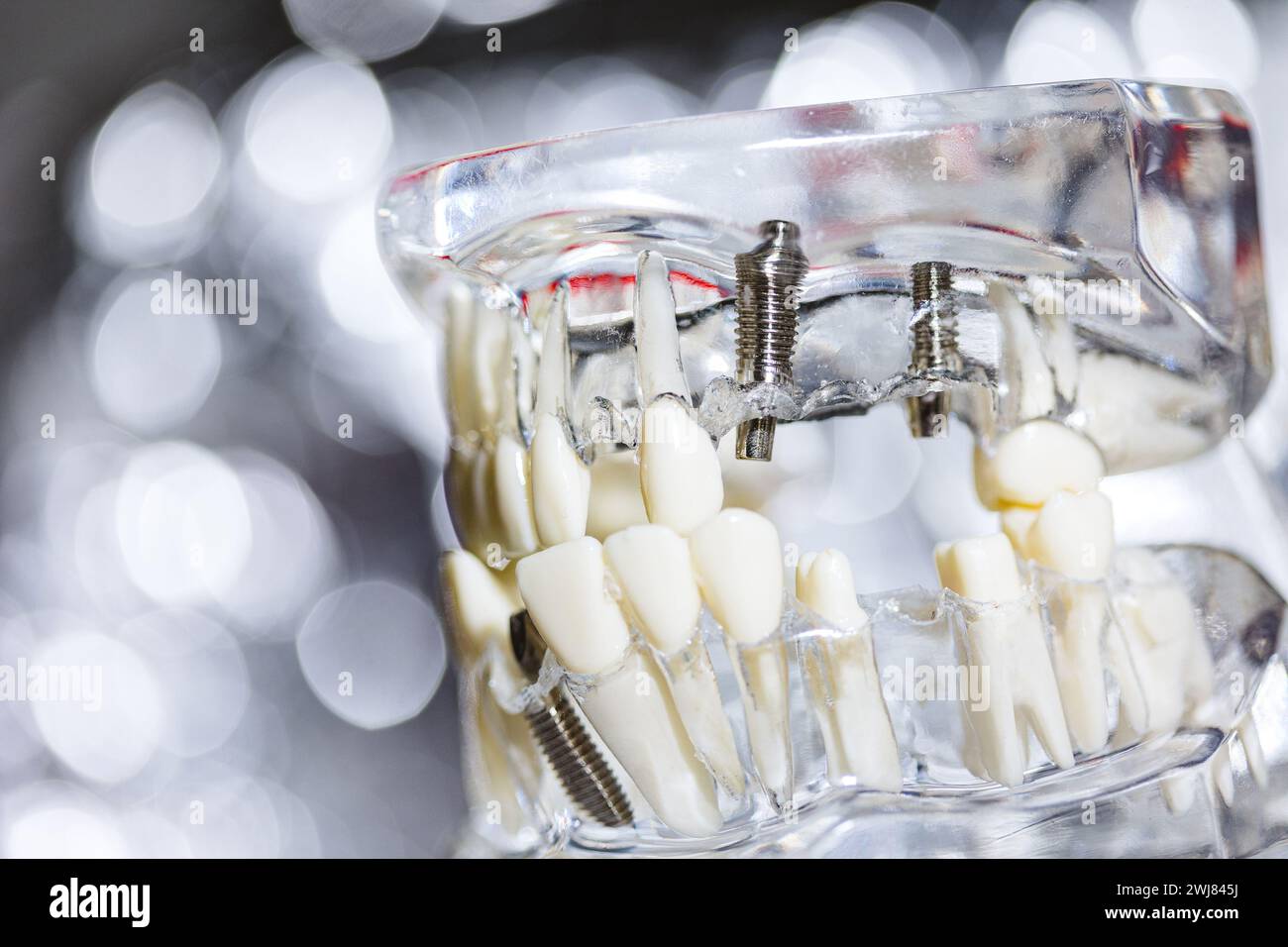 Dental tooth implant titanium prosthetic dentists model. Shallow dof ...