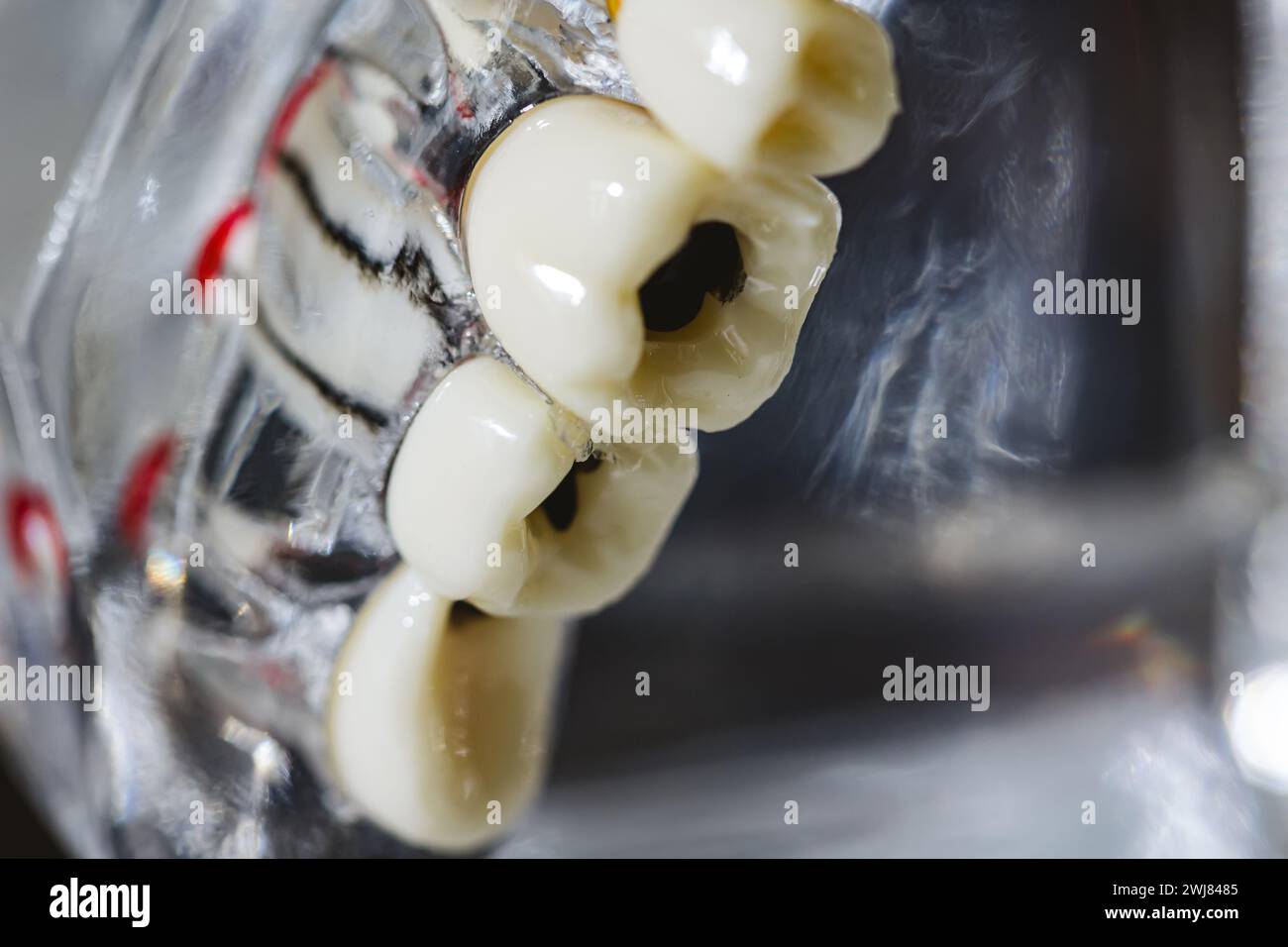 Caries tooth model, oral care concept. Dental model present common ...