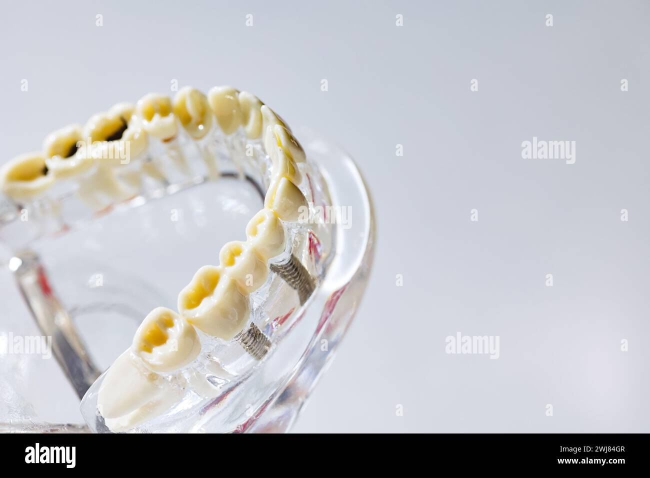 Caries tooth model, oral care concept. Dental model present common ...