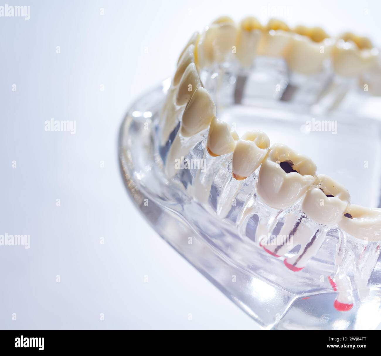 Dental implant, artificial tooth roots into jaw, root canal of dental ...