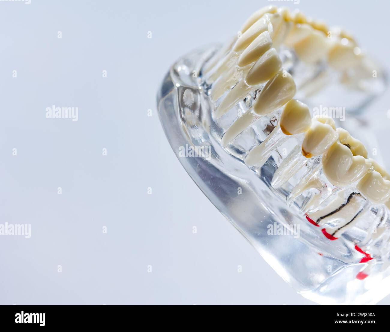 Dental implant, artificial tooth roots into jaw, root canal of dental ...