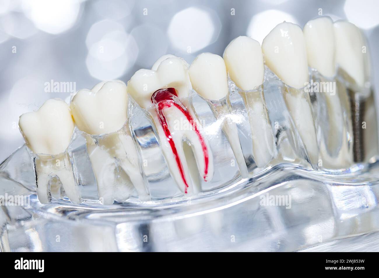 Dental implant, artificial tooth roots into jaw, root canal of dental ...
