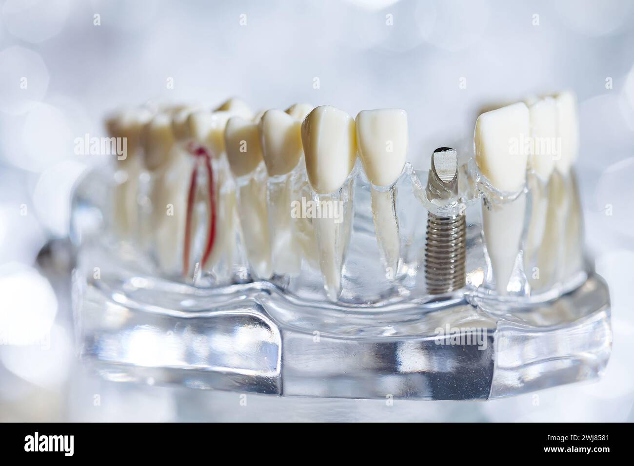 Dental tooth implant titanium prosthetic dentists model. Shallow dof ...