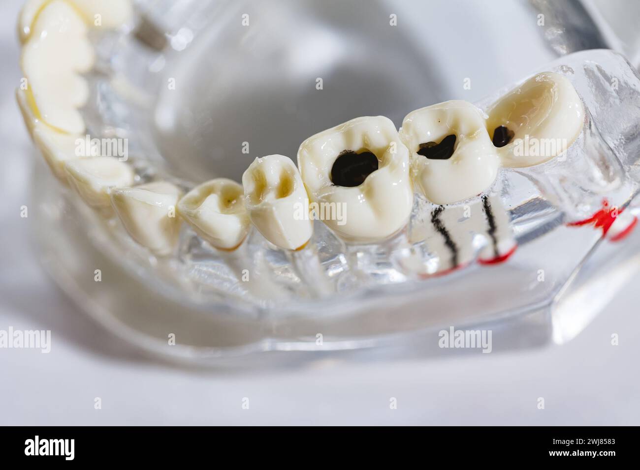 Caries tooth model, oral care concept. Dental model present common ...