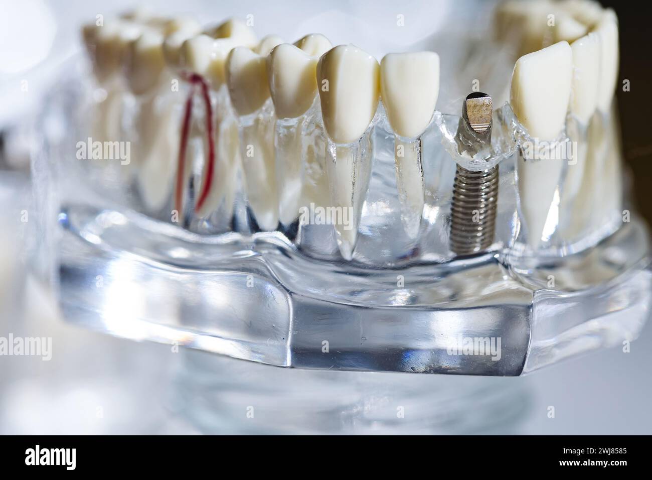 Dental tooth implant titanium prosthetic dentists model. Shallow dof ...